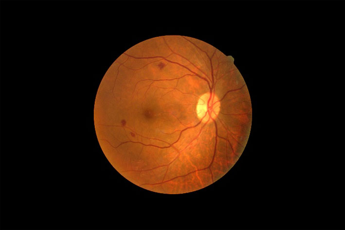 Diabetic Retinopathy Treatment Fredericksburg & King George